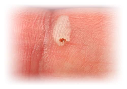 Feigwarzen Oder Fibrome? : Stielwarzen Krankheiten Symptome – MRQOI