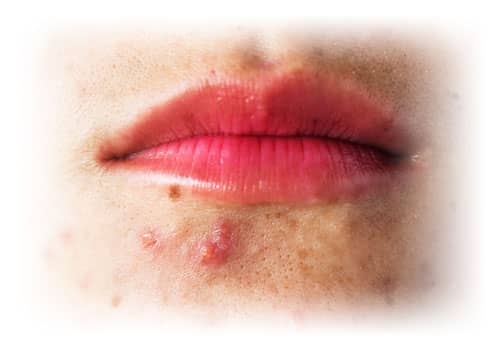 Was versteht man unter Hautgrieß? | McApotheke.com